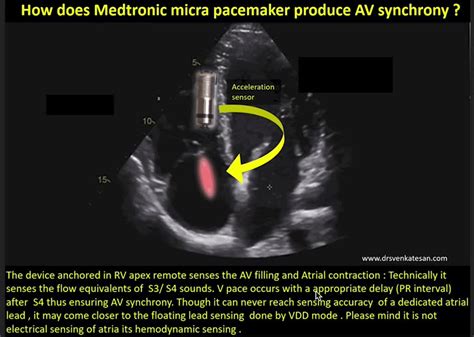 [video] Dr P K Hazra On Linkedin Medtronic Double Chamber Micra