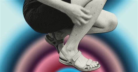 How To Heal Bug Bites Fast How To Heal Bug Bites Fast