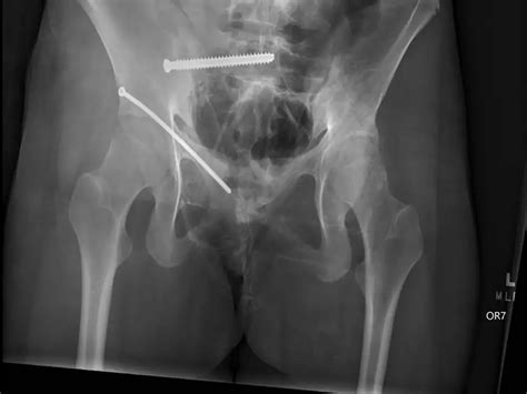 Teen Girl Suffered Fractured Pelvis In Fleet Week Navy Parachutist