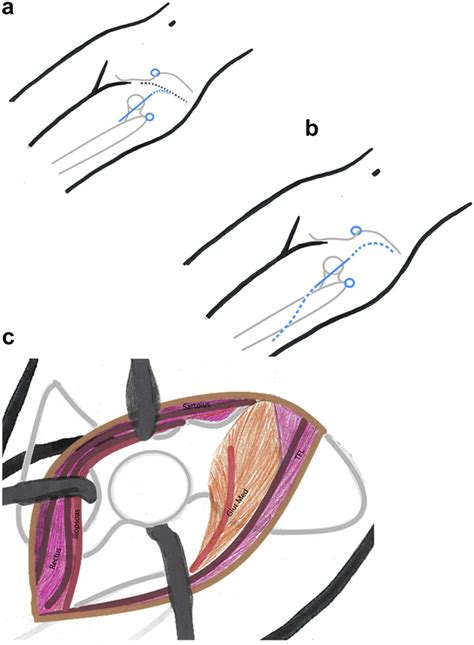 A Standard Daa B Dotted Line Delineating The Extensile Incision