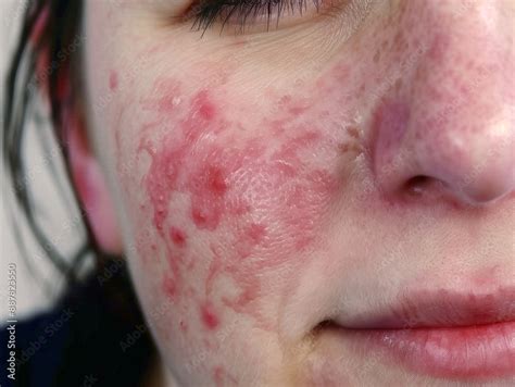 Rosacea And Skin Conditions Womens Faces Treatment Close Up Of