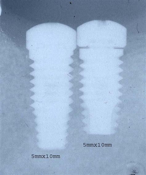 Biomet 3i NanoTite Parallel Walled Zahnimplantat SpotImplant