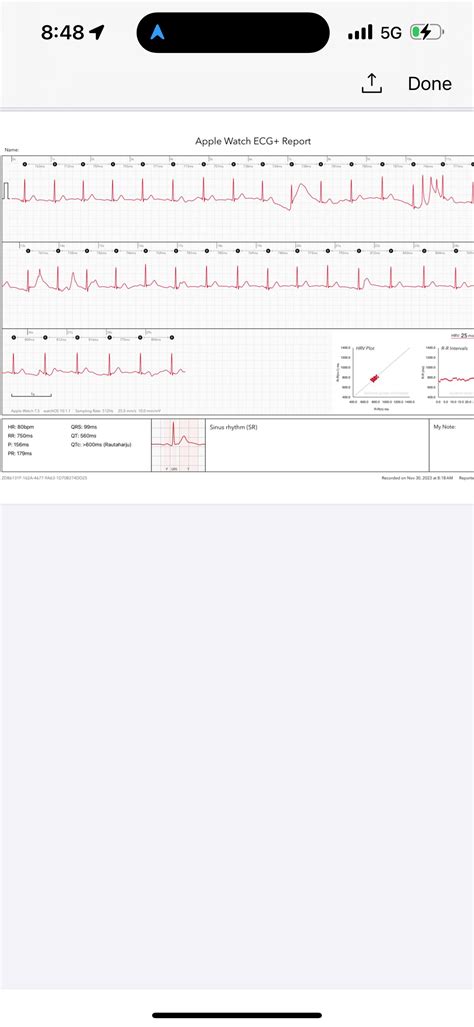 Is This Normal I Been Diagnosed With Afib R Afib