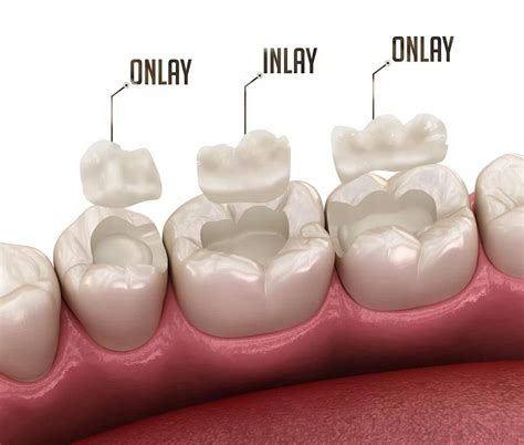 Inlay Onlay Overlay Actualités