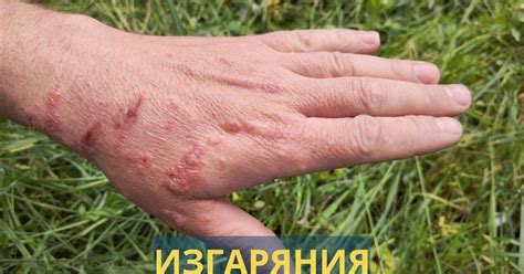 Как се лекуват изгаряния по кожата R Zdrave
