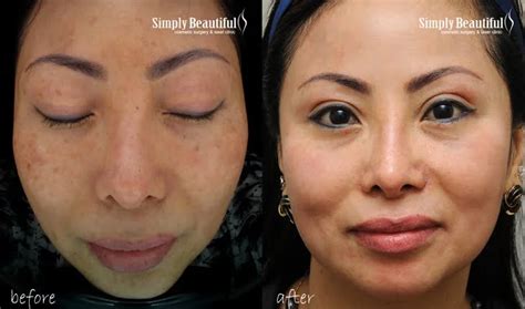 Laser Skin Whitening Rejuvenation Dr Peter Kim Surgery Skin