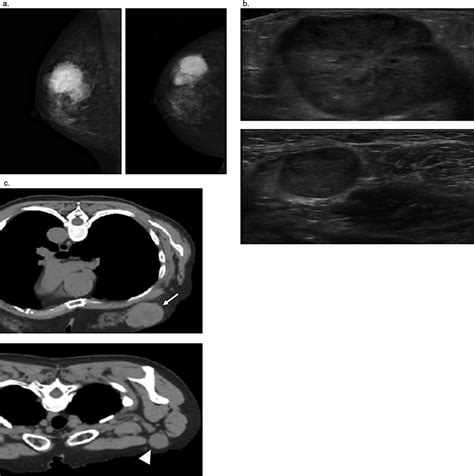 Mg Us And Ct Imaging Of The Right Breast And Axilla A Mlo Left And