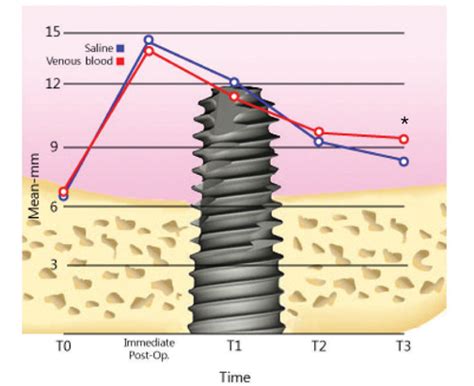 20 Cases Of Hydraulic Sinus Membrane Elevation Via Crestal Approach