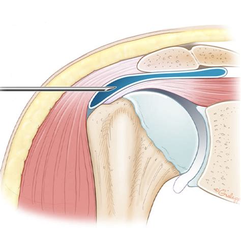 Shoulder Impingement And Subacromial Bursitis