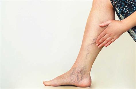 7 Ways How Varicose Vein Injection Works A Comprehensive Guide