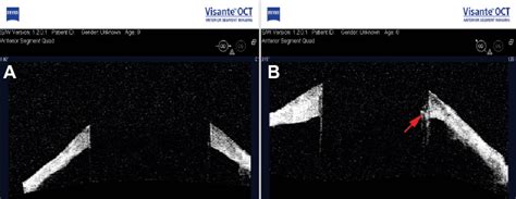 Figure 2 From Clinical Ophthalmology Dovepress Dovepress Comparison Of