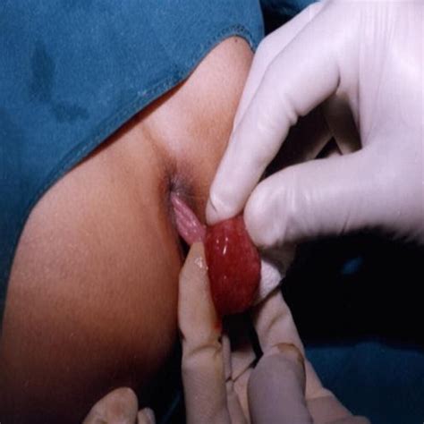 Award Winning Colorectal Polyp Specialist Experienced Colorectal