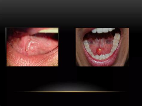 Soft Tissue Calcifications Of The Oral Cavity Pptx