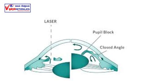 Laser Peripheral Iridotomy Preventing Glaucoma Changing Lives