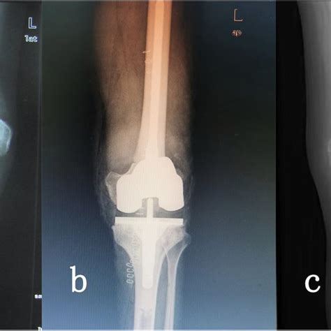 A 37 Year Old Man Case 1 With Recurvatum Deformity On Femur Was Download Scientific Diagram
