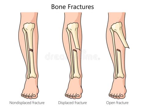 Types Of Bone Fractures Diagram Medical Science Stock Vector