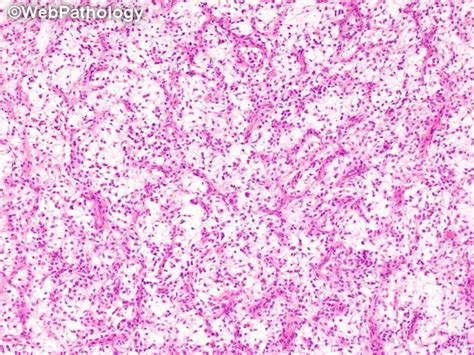 Myxoid Liposarcoma Additional Images