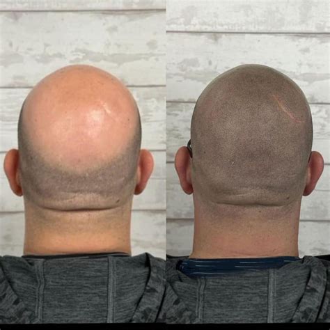 Scalp Micropigmentation Smp For Male Pattern Baldness Alabama