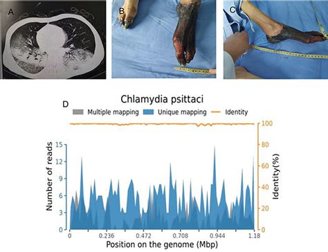 A Chest Computed Tomography Ct Revealed Diffuse Bilateral And Download Scientific Diagram