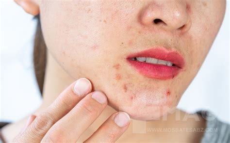 کمبود کدام ویتامین باعث ایجاد لکه های قرمز روی پوست میشود؟