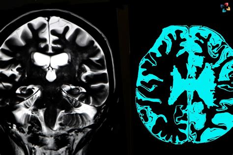 Cerebral Atrophy Causes Symptoms And Treatment Options The Lifesciences Magazine