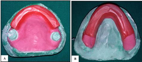 Figure 3 From Cu Sil Denture An Innovative Approach To Preserve The