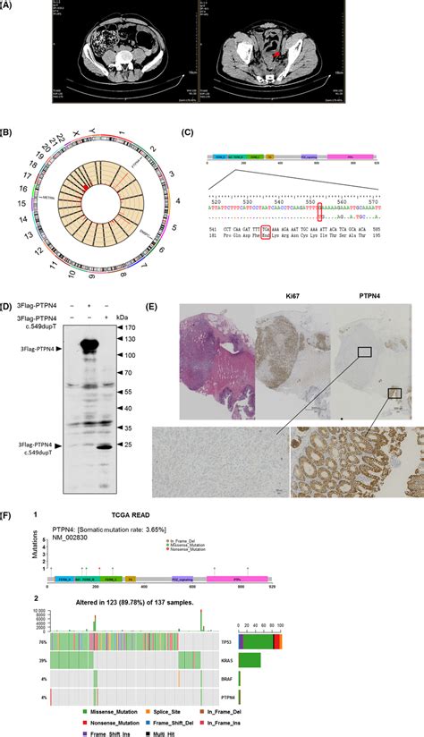 A Nonsense Mutation Of Ptpn4 Is Identified In 1 Case Of Rectal Cancer