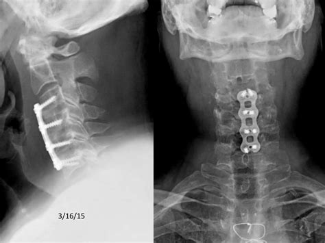 Pseudarthrosis Cervical Spine Ppt