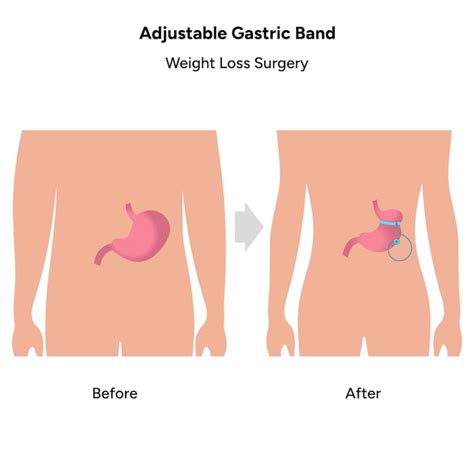 Premium Vector Adjustable Gastric Band Bariatric Surgery Procedures