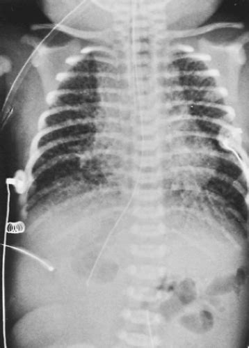 Cardiac Malposition And Heterotaxy Musculoskeletal Key