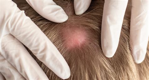 ¿qué Es La Foliculitis Su Impacto En El Cabello Imd