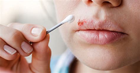 Herpes Viral Sintomas E Tratamentos