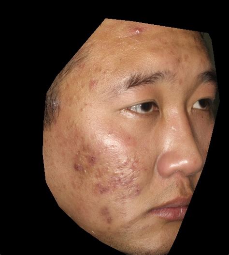 acne detection classification dataset and pre trained model by