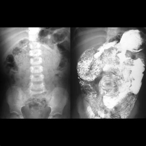 Preschooler With Abdominal Pain Pediatric Radiology Case
