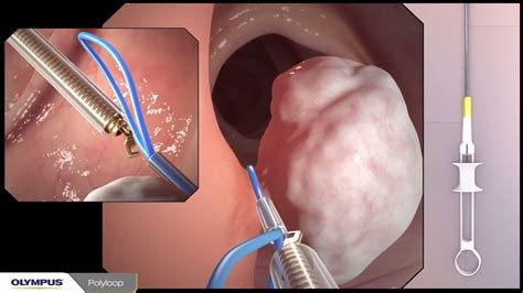 Colonoscopy Polyp Removal