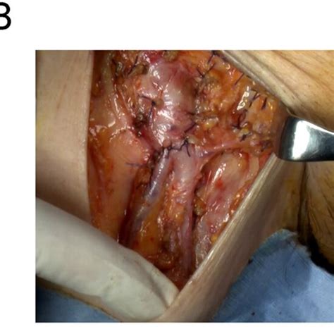 Photographs And Anatomical Drawings After Inguinal Lymph Node Download Scientific Diagram