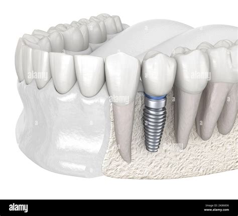 Premolar Tooth Recovery With Implant Medically Accurate 3d