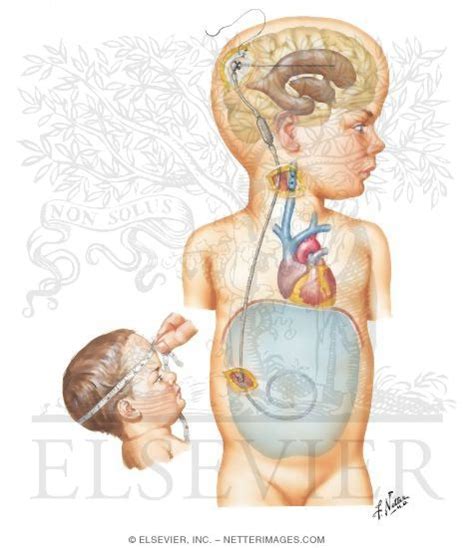 Hydrocephalus Shunt Placement