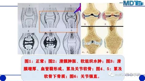 【ppt】类风湿关节炎的影像诊断 影像ppt