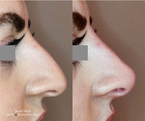 Anti Ageing Injectables And Dermal Fillers The Female Health Clinic