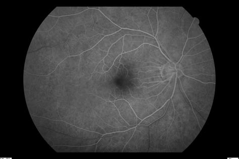 Vessel Enhancement Dengan Hessian Matrix Dari Gauge Coordinate Dr