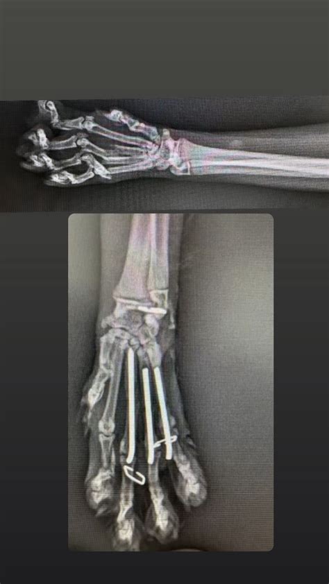 Yunus Toker On Linkedin Cat Metacarpal Fracture Repair With Pins 👍🏻
