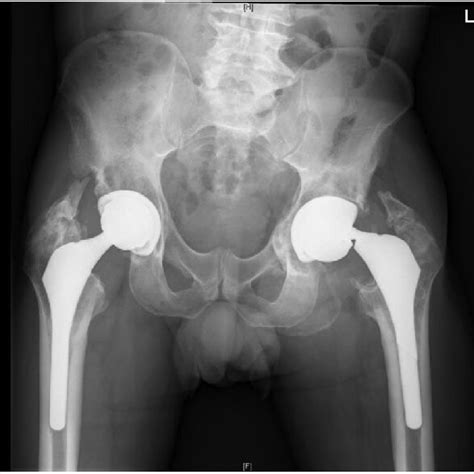 Axial T2 Mars Mri Pelvis With Contrast Demonstrates Pseudotumor