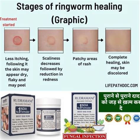 Itch Cream Ringworm Antifungal Cream Rudramani Ringworm Ointment 25gm