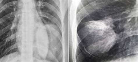 Ab Large Abc Of The Rib Giant Cell Tumor Gct As Compared With Long Download Scientific