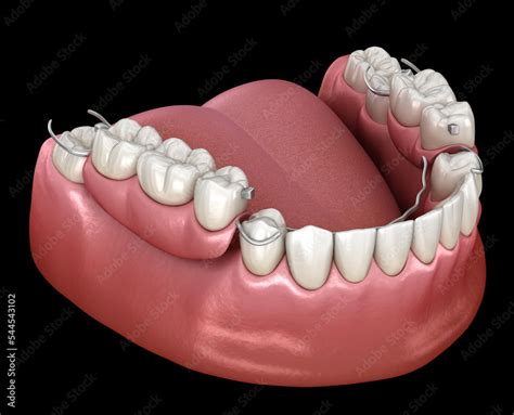 Removable Partial Denture Mandibular Prosthesis Medically Accurate 3d