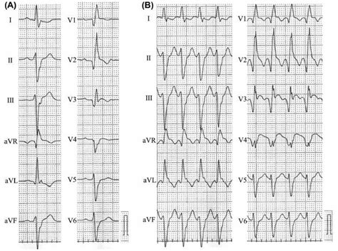 Qrs