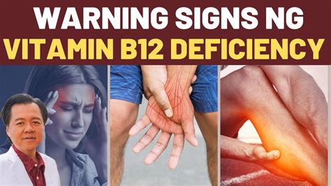 Doc Willie Ong 9 Warning Signs Na Kulang Ka Sa Vitamin