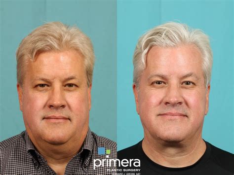 Coke Nose Before And After