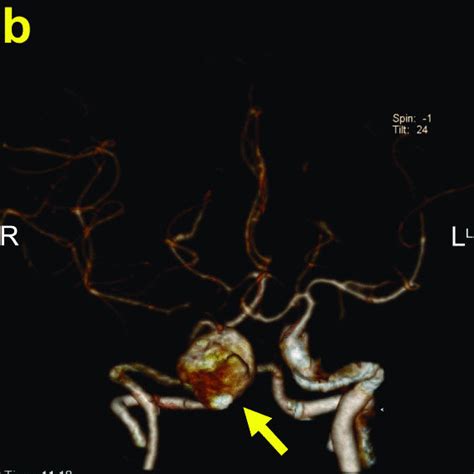 Patient 3s Pre And Postoperative Imaging Of Ica Balloon Download Scientific Diagram